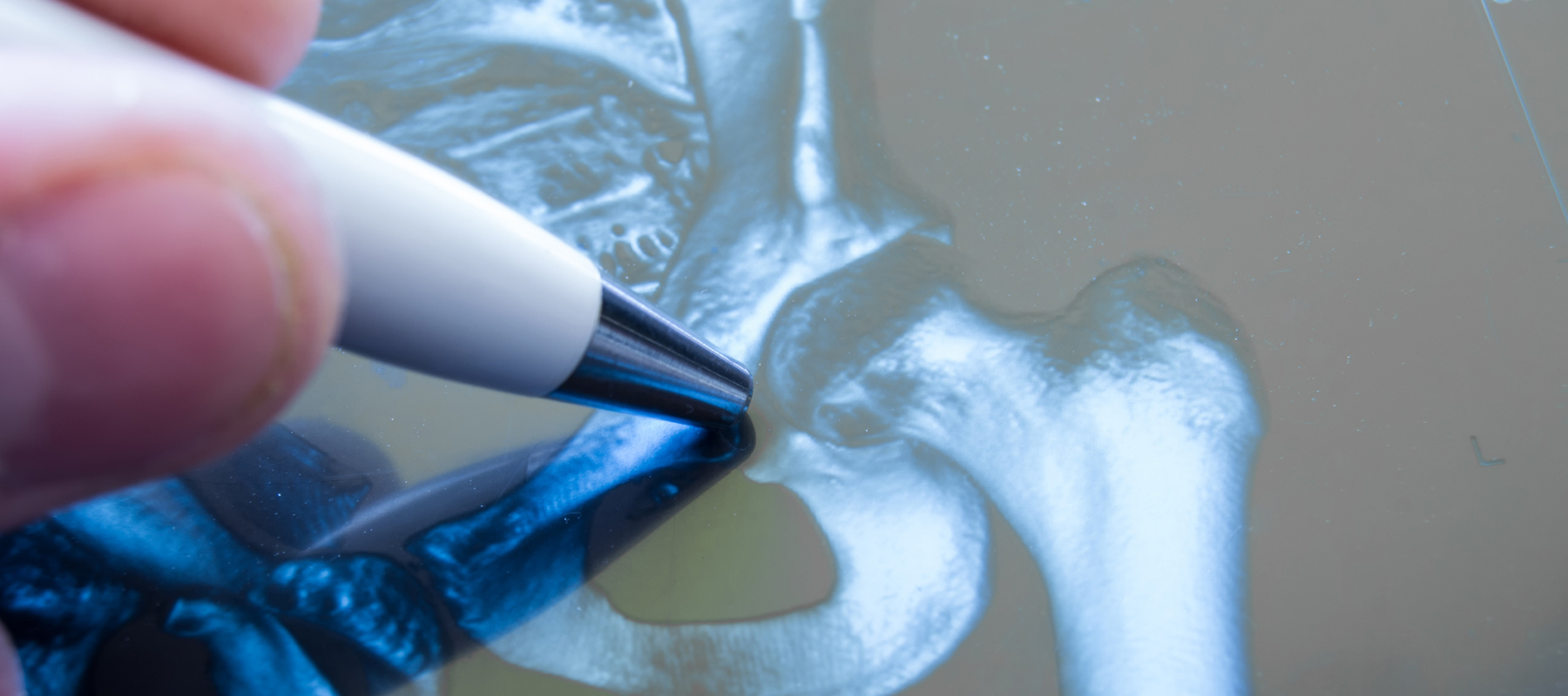 Chirurgia dell'anca, un'equipe di super specialisti per Humanitas ...